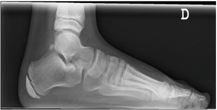 Clinical Presentation and Management of Trigonum Bone Syndrome in a ...