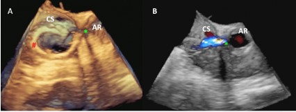 Aorta-Right Atrial Fistula after Tricuspid Valve Repair