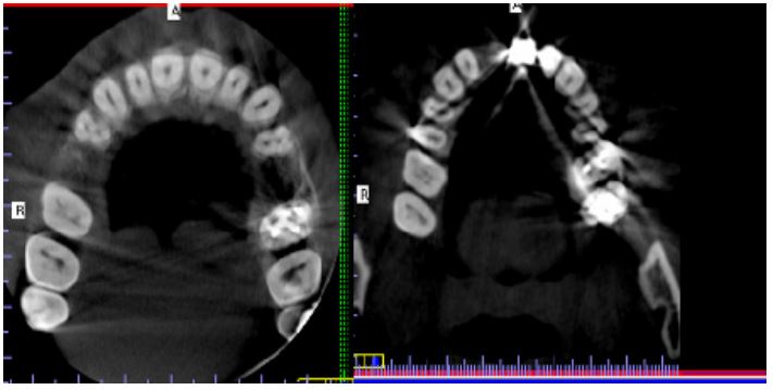 Analysis of Artefacts in Endodontically Treated Teeth on Cone Beam ...
