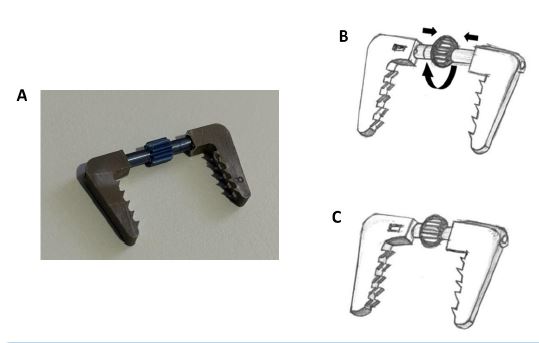 Sternette®: An Alternative Closure Device after Median Sternotomy