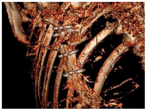 Sternette®: An Alternative Closure Device after Median Sternotomy