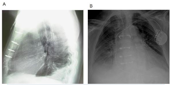 Sternette®: An Alternative Closure Device after Median Sternotomy