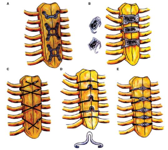 Sternette®: An Alternative Closure Device after Median Sternotomy